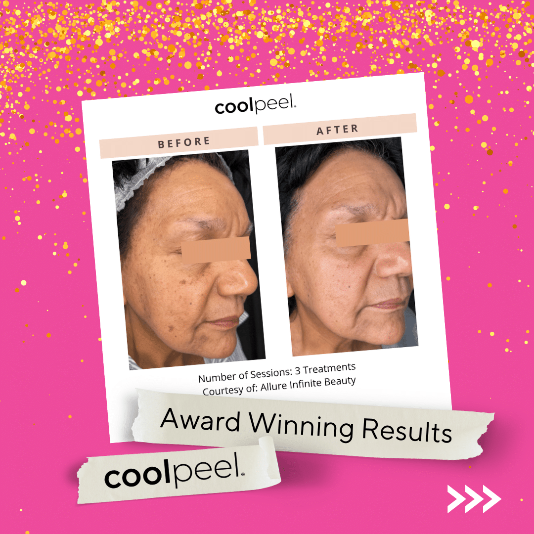 Co2 Cool Peel - 719 Revive Med Spa, LLC Co2 Cool Peel - 719 Revive Med Spa, LLC