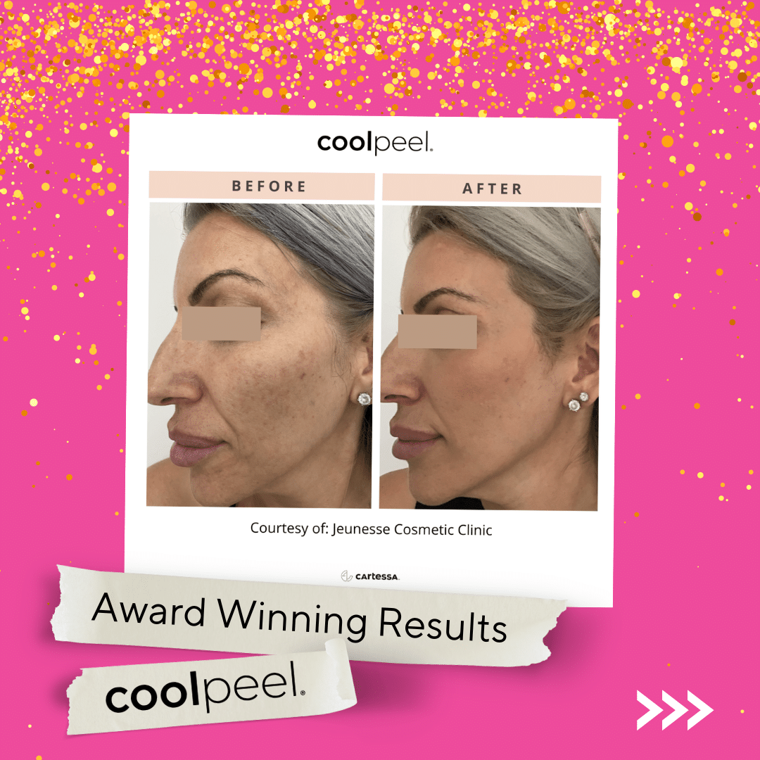 Co2 Cool Peel - 719 Revive Med Spa, LLC Co2 Cool Peel - 719 Revive Med Spa, LLC